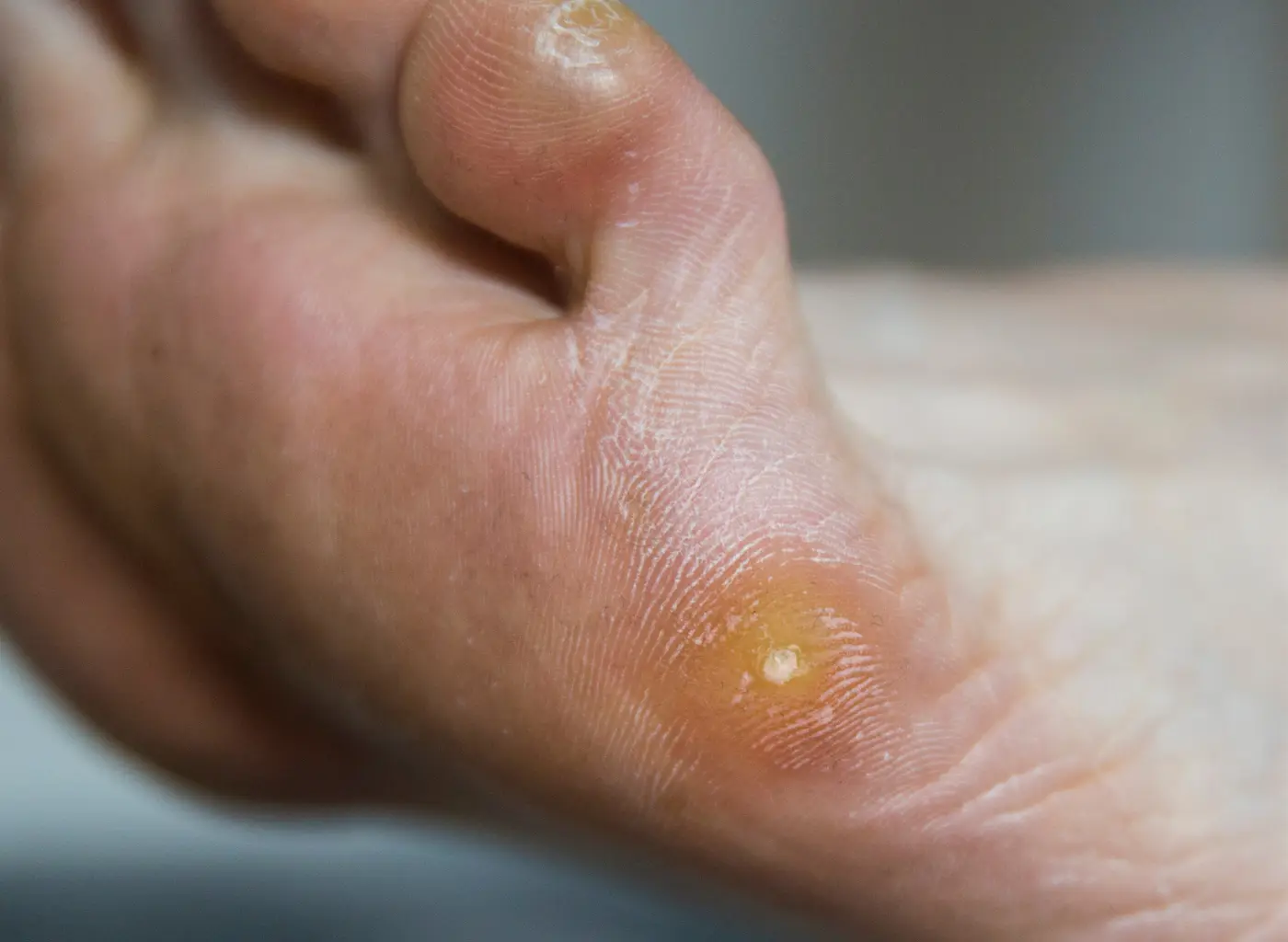 Corns V’s Callus: What’s the difference - Maroochy Podiatry